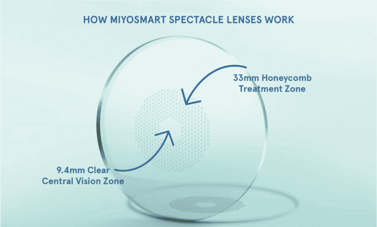 MiYOSMART Lenses | Slow Your Child's Myopia by Up to 60% | Eye Care for ...